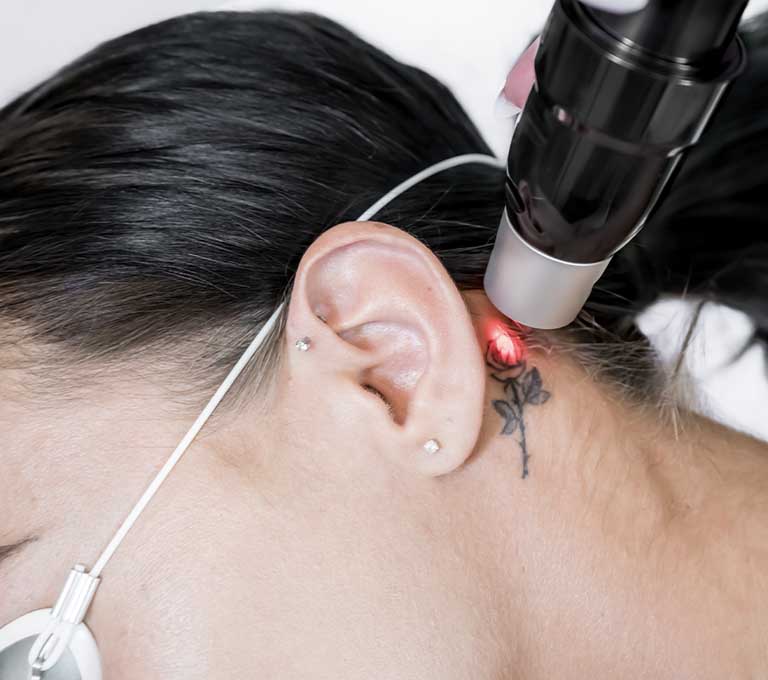 Laser Tattoo Removal | Emma J Aesthetics | Inverness Skin Clinic